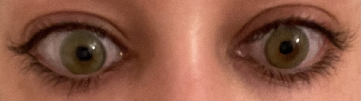 Limbal Ring Contact Lenses